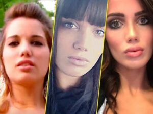 Manon Marsault avant après - Blog Univers-med