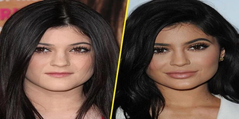 kylie jenner avant chirurgie et maintenant : L’évolution beauté