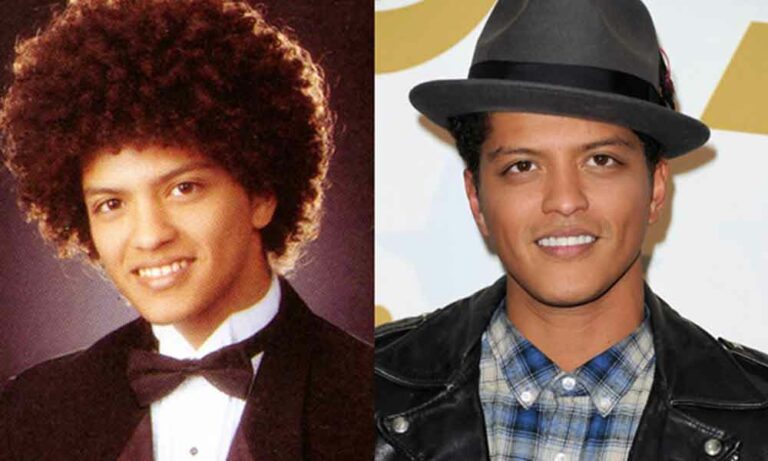 bruno mars dents avant chirurgie et apres photos